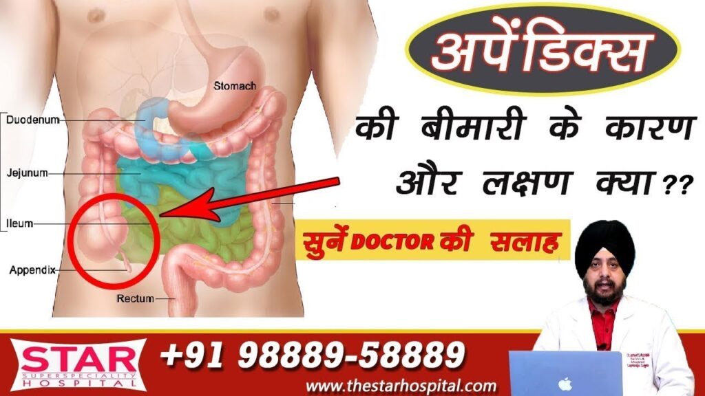 अपेंडिक्स, (Appendix) – प्रकार, लक्षण, कारण, इलाज और परहेज - Appendix in Hindi