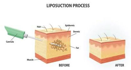 Liposuction Surgery Centre in Jalandhar 【#1】 Liposuction Treatment Punjab
