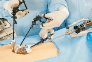 Mini Laparoscopic Surgery | Mini Laparoscopic Surgeon in India