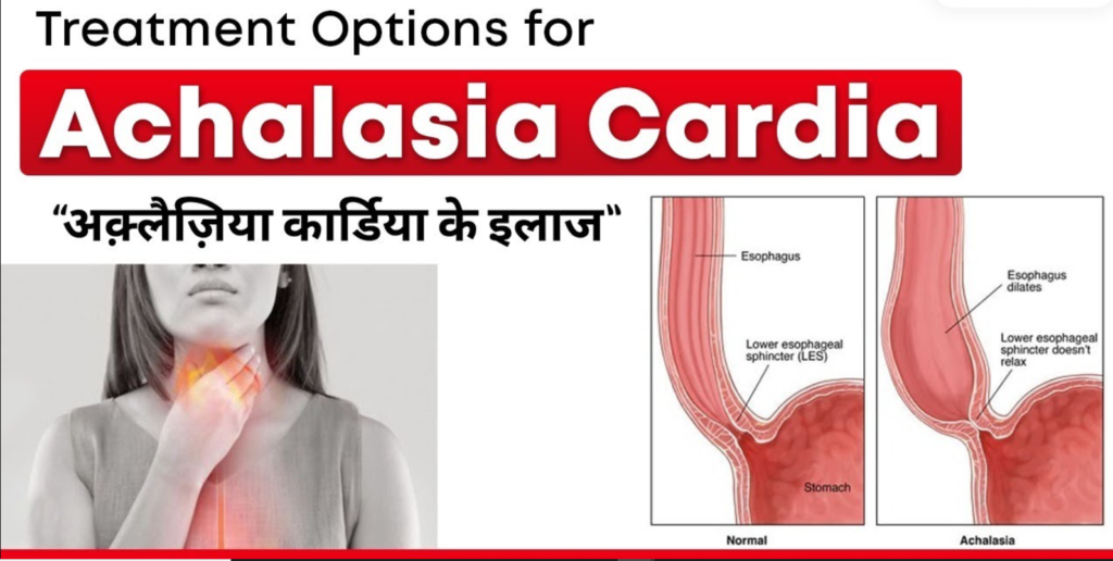 Achalasia Cardia treatment India | Causes & Symptoms of Achalasia