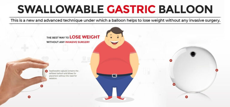 Swallowable Gastric Balloon Cost | Swallow Pill For Weight Loss In India