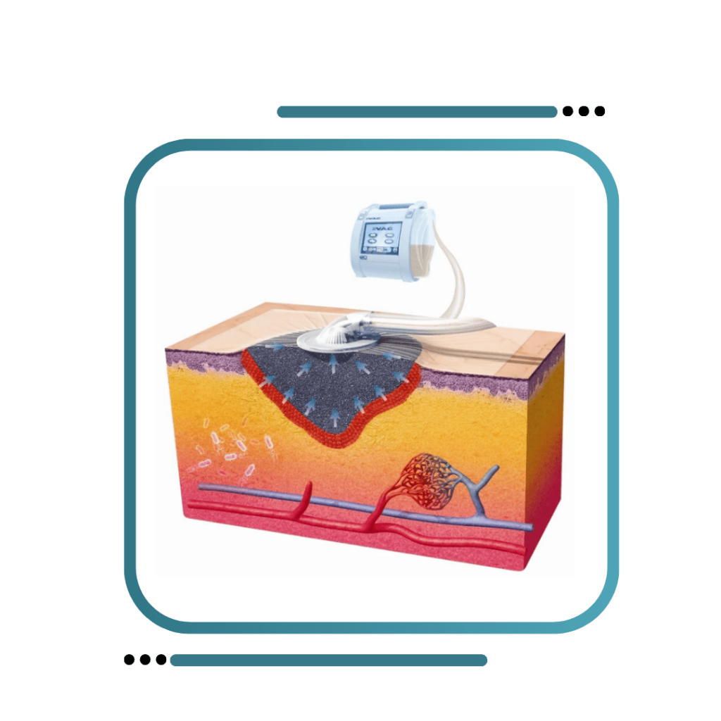 Vacuum Assisted Closure ( VAC ) Therapy India | Chronic Wound