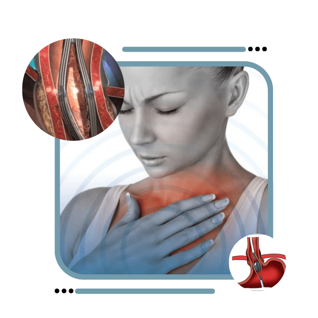 Stretta Therapy in India | Best Hospital for Stretta Treatment India